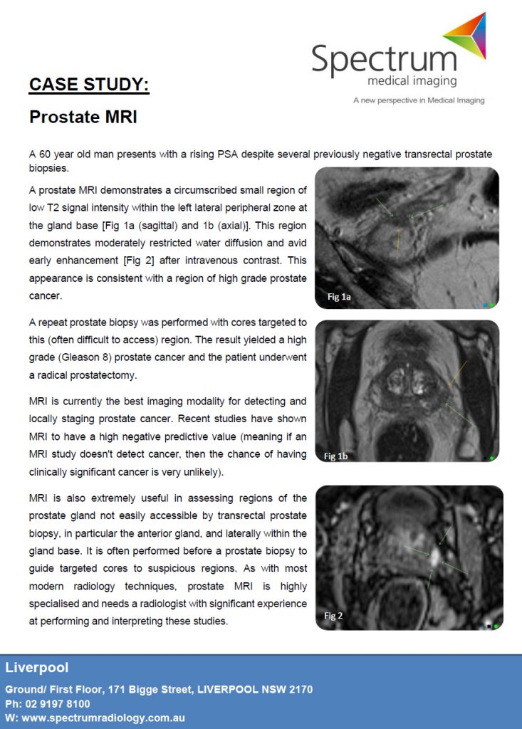 Prostate MRI – A Case Study – GP Voice
