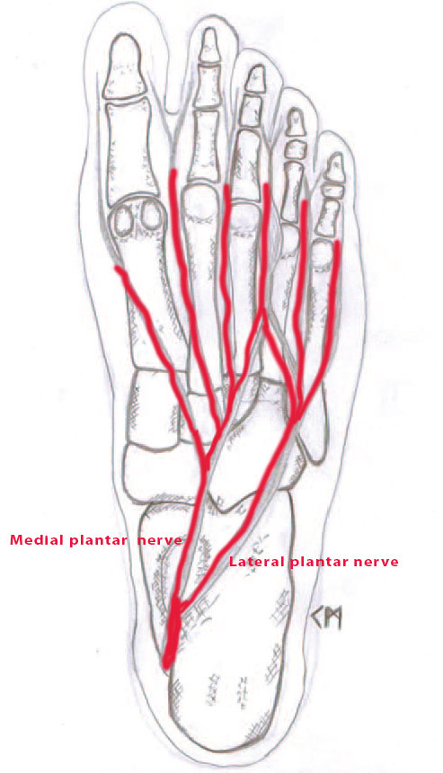 Morton’s Neuroma – is it a neuroma? – GP Voice