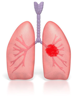 ACE Inhibitors & Lung Cancer – is it for real? – GP Voice