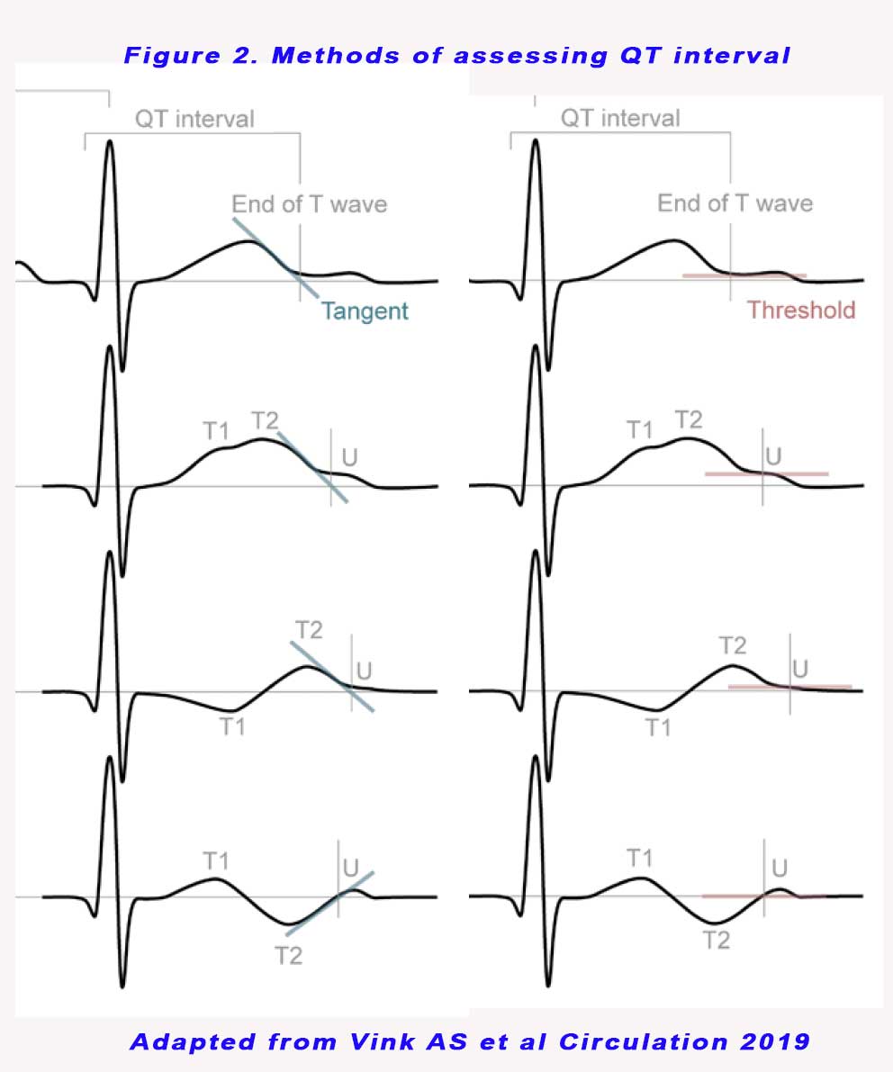QT interval – how long is too long? Is it relevant in GP? – GP Voice