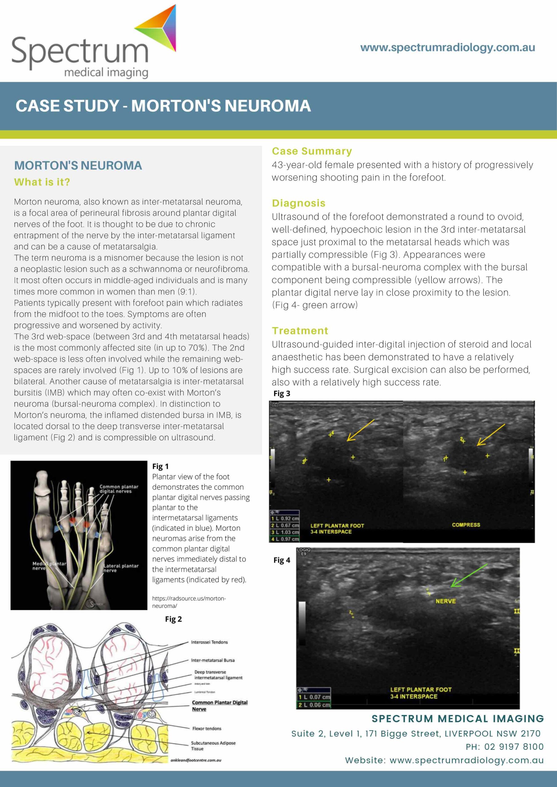 Morton’s Neuroma – A case study – GP Voice
