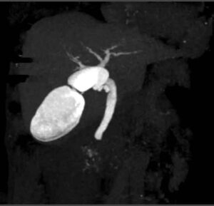 CT cholangiogram – when should we order one? – GP Voice