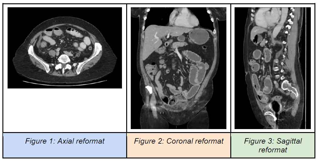 Role of CT Enterography in Crohn’s Disease Mx – GP Voice