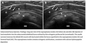 Shoulder bursitis – diagnosis and management – GP Voice