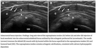 Shoulder bursitis – diagnosis and management – GP Voice