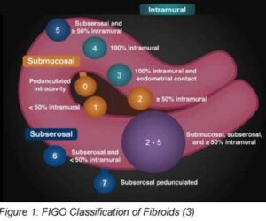 Uterine fibroids – diagnosis and management – GP Voice