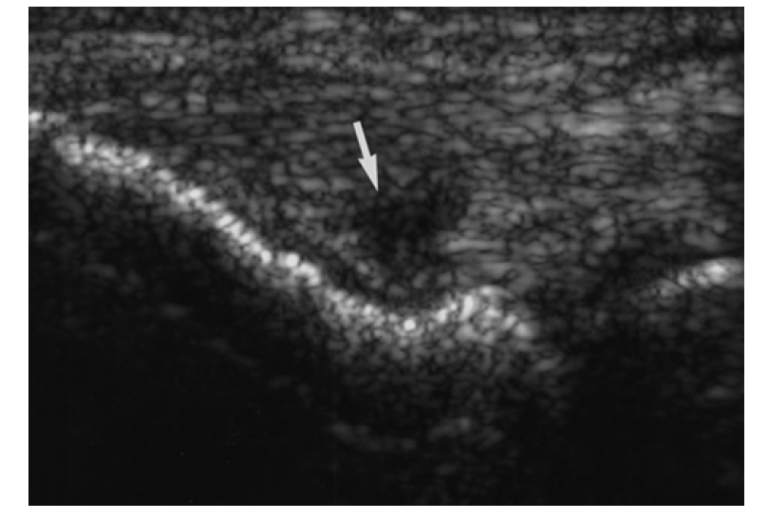 Tennis Elbow – diagnosis and management in one go – GP Voice