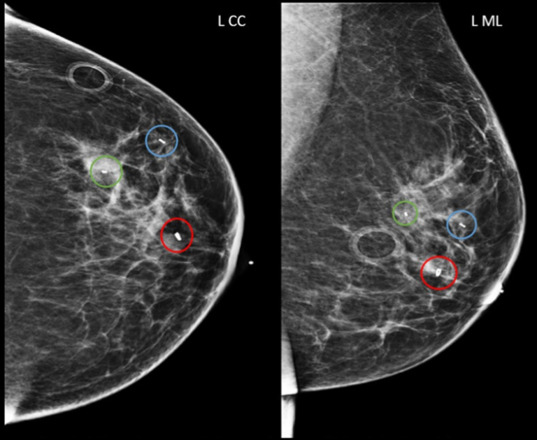 Breast markers and clips – what are they? – GP Voice