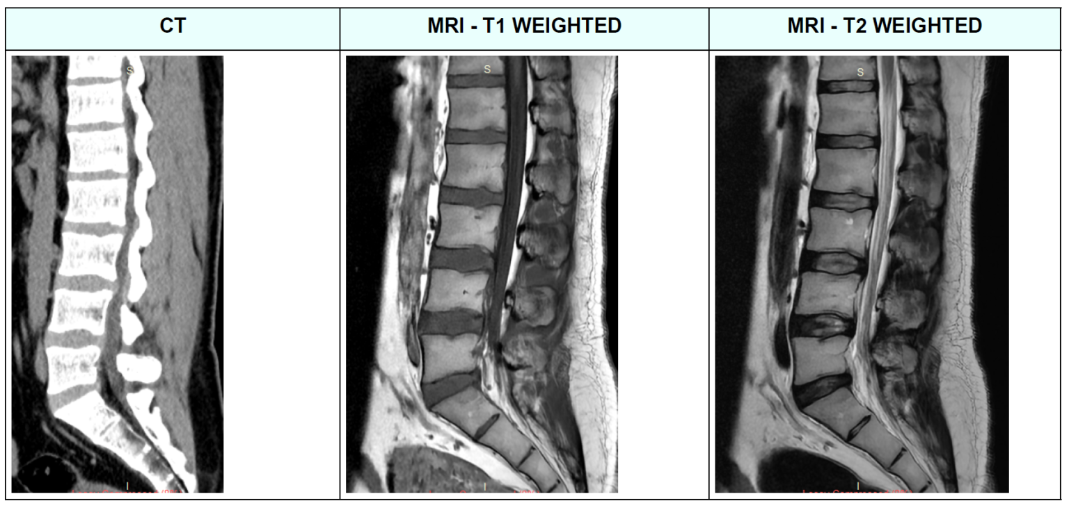 Low back pain diagnosis – CT or MRI? – GP Voice