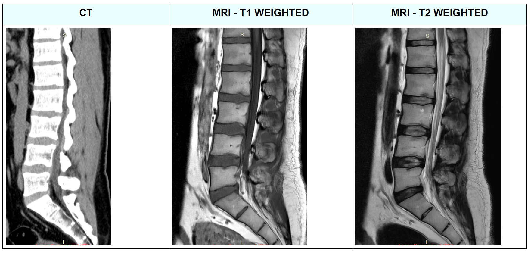 Low back pain diagnosis – CT or MRI? – GP Voice
